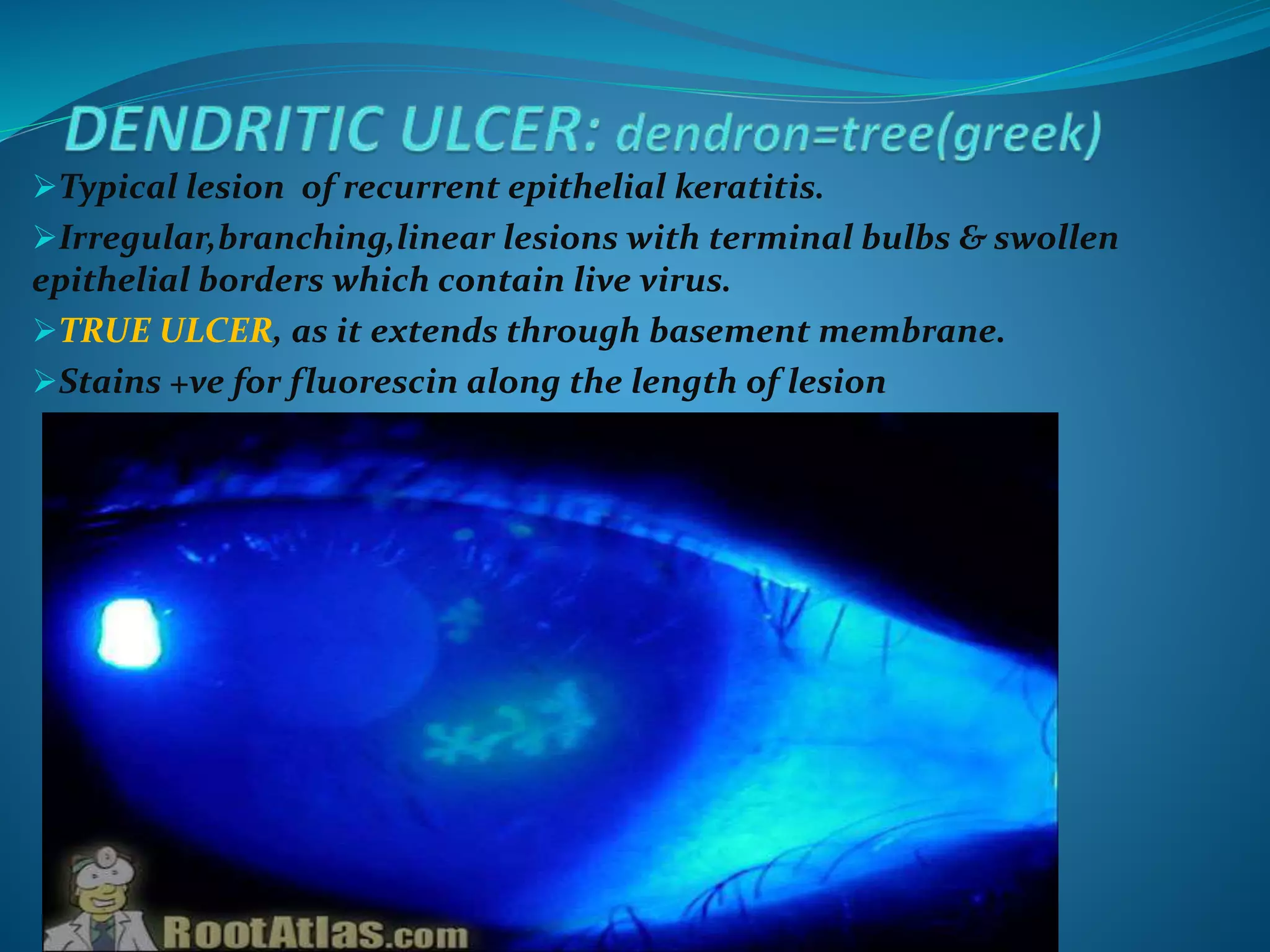 ETIOLOGY, PATHOLOGY AND PATHOGENESIS OF CORNEAL ULCER | PPTX