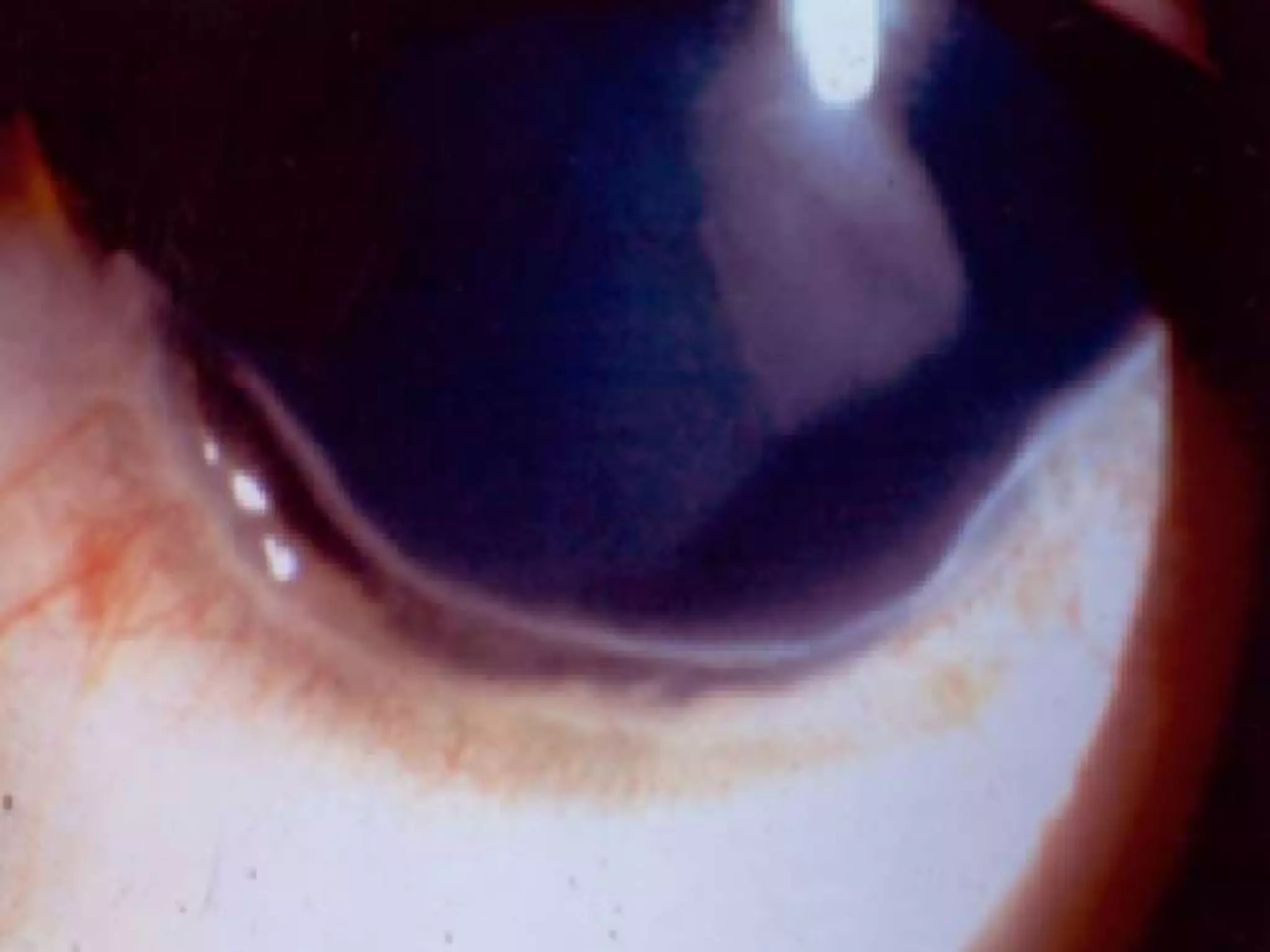 ETIOLOGY, PATHOLOGY AND PATHOGENESIS OF CORNEAL ULCER | PPTX