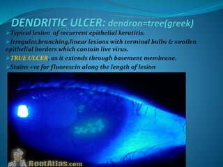 ETIOLOGY, PATHOLOGY AND PATHOGENESIS OF CORNEAL ULCER | PPT