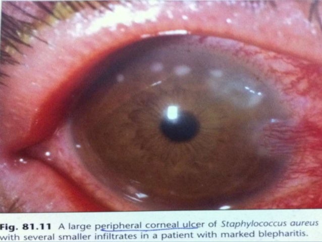 ETIOLOGY, PATHOLOGY AND PATHOGENESIS OF CORNEAL ULCER