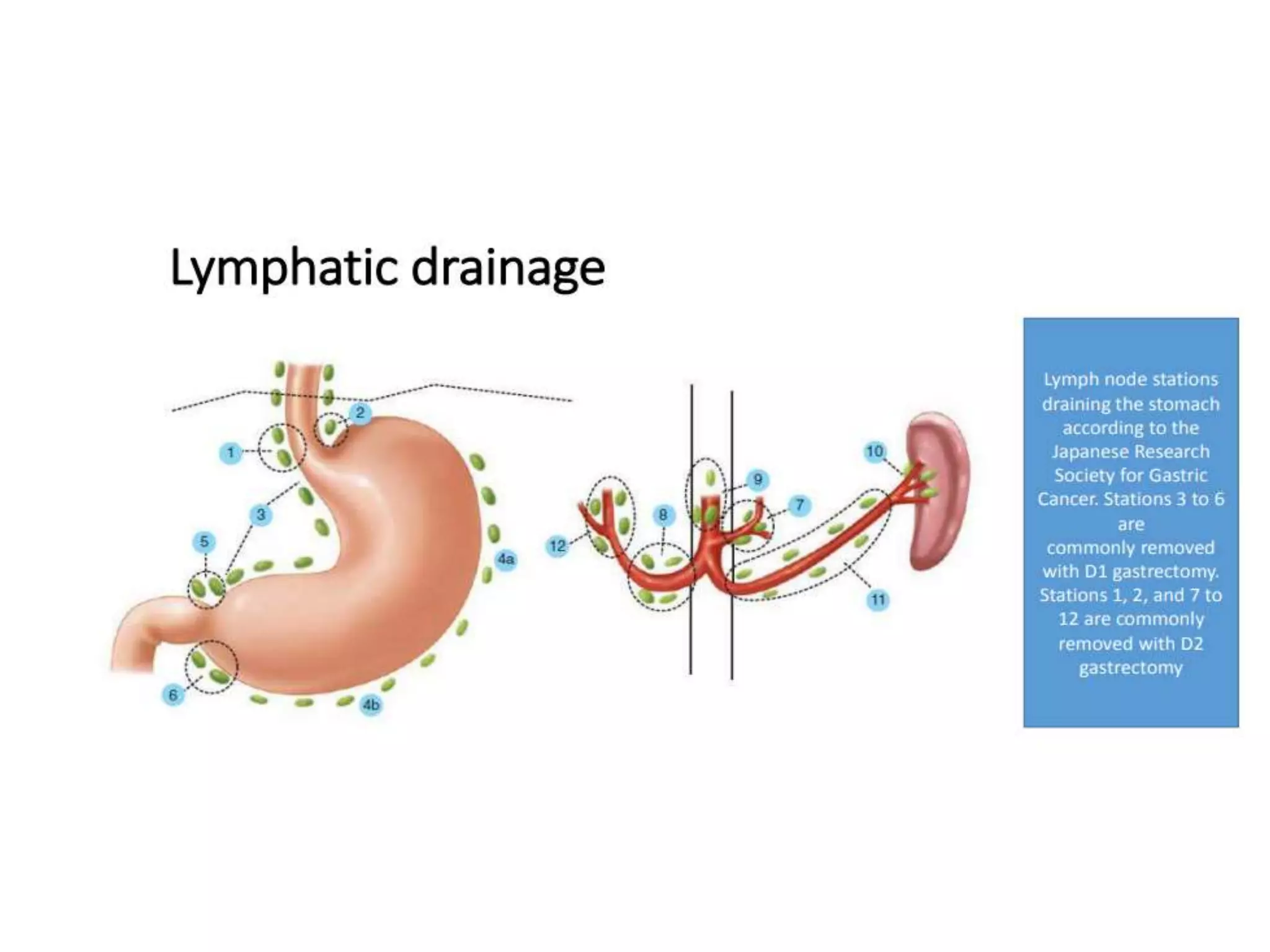 Etiopathogenesis and staging of gastric cancer | PPTX
