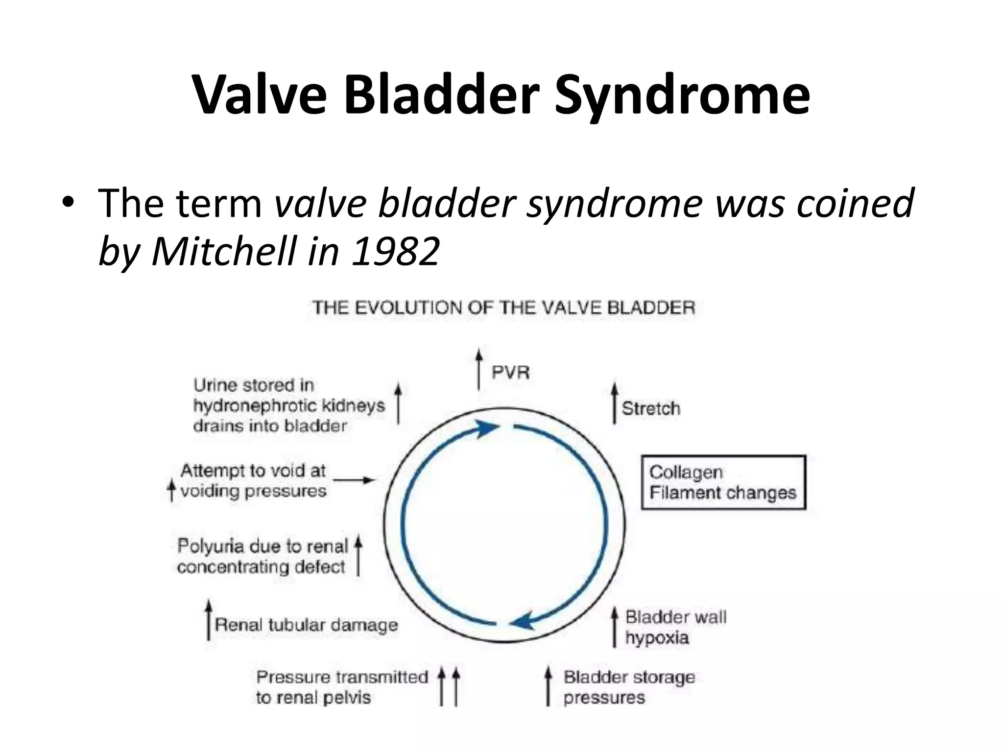 Etiopathogenesis, Evaluation & Management of Posterior Urethral Valve ...