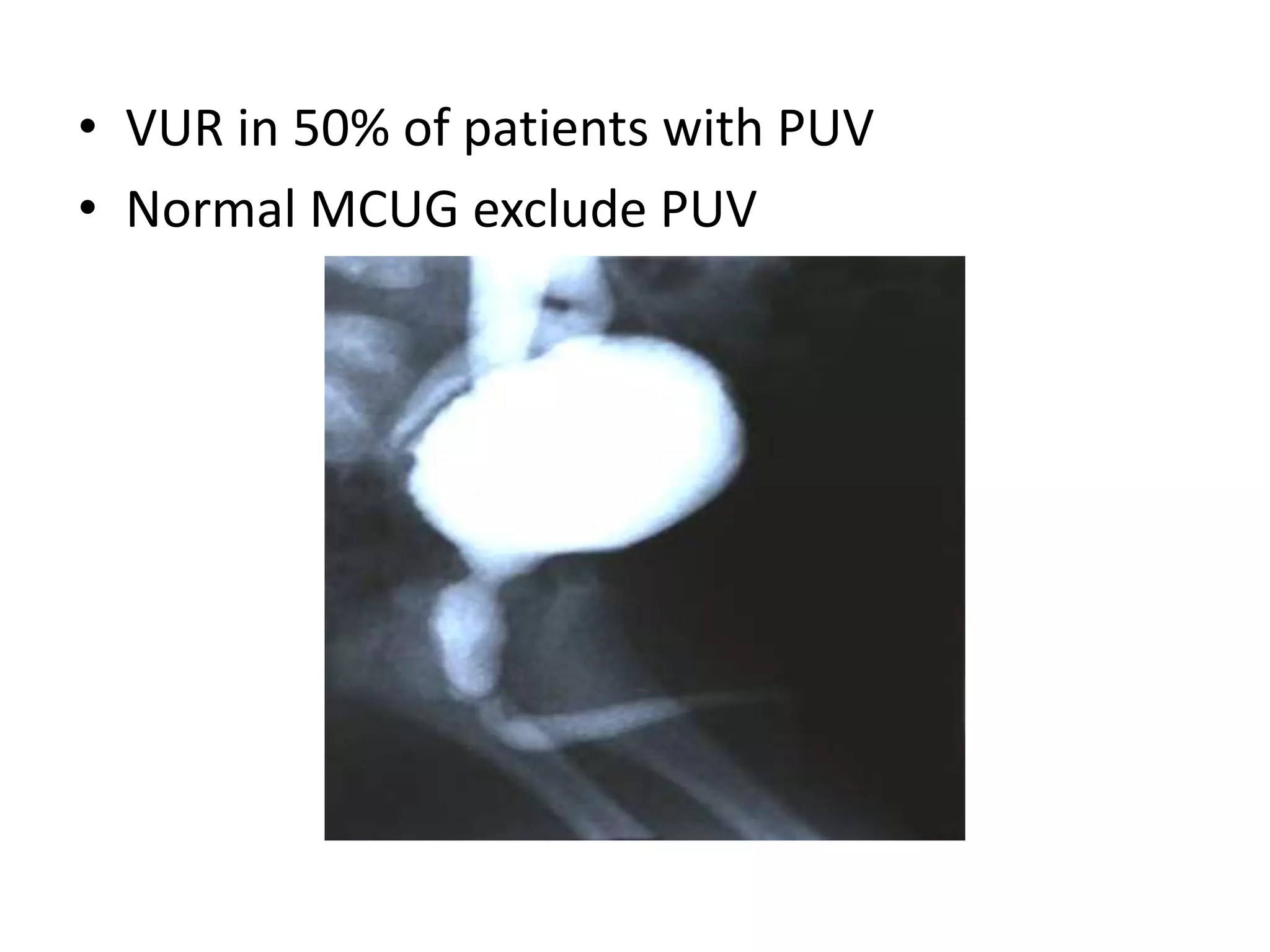 Etiopathogenesis, Evaluation & Management of Posterior Urethral Valve ...