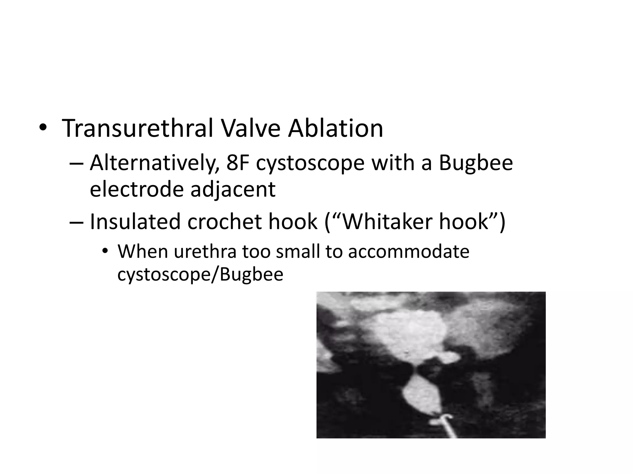 Etiopathogenesis, Evaluation & Management of Posterior Urethral Valve ...