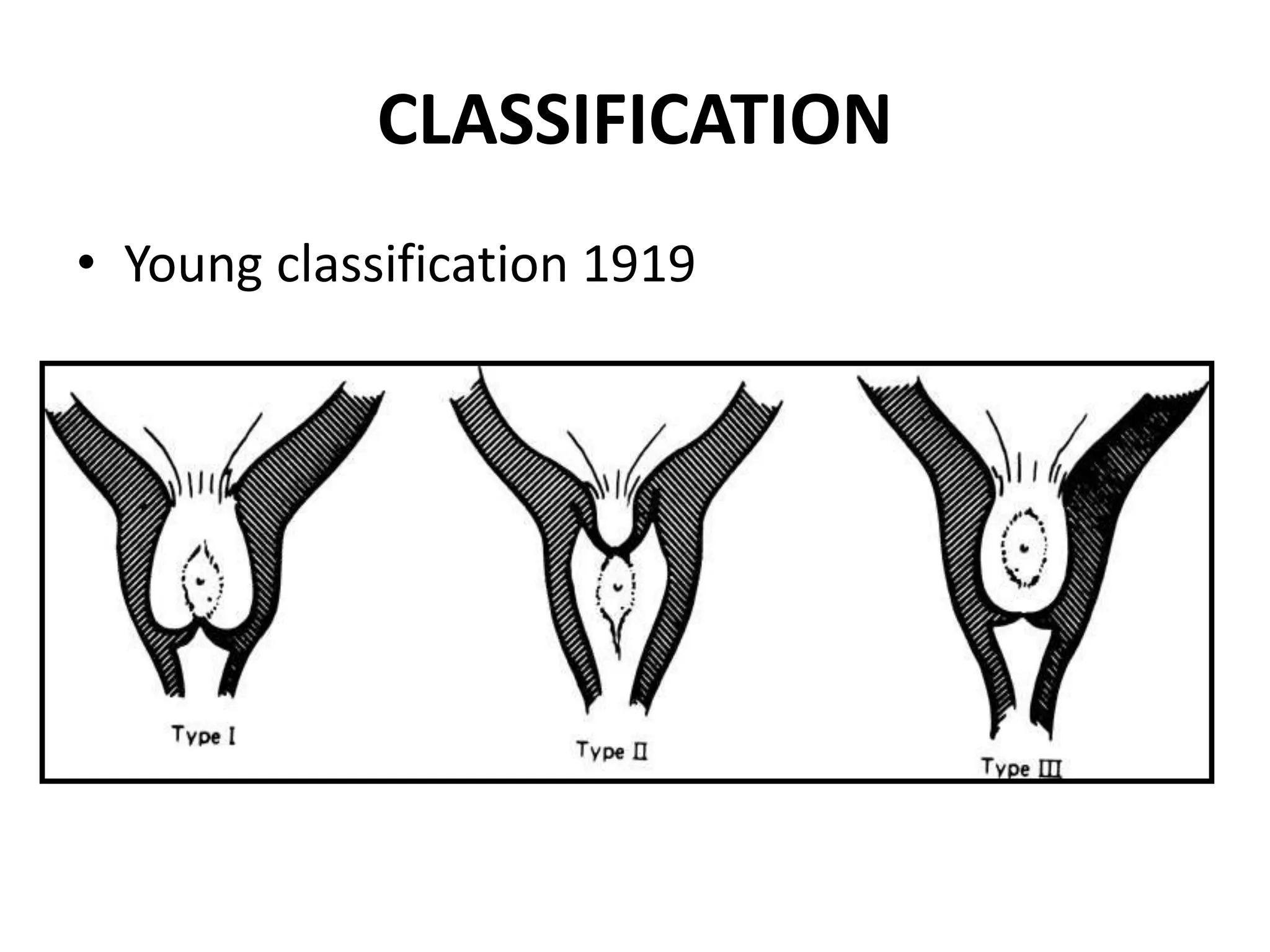 Etiopathogenesis, Evaluation & Management of Posterior Urethral Valve ...