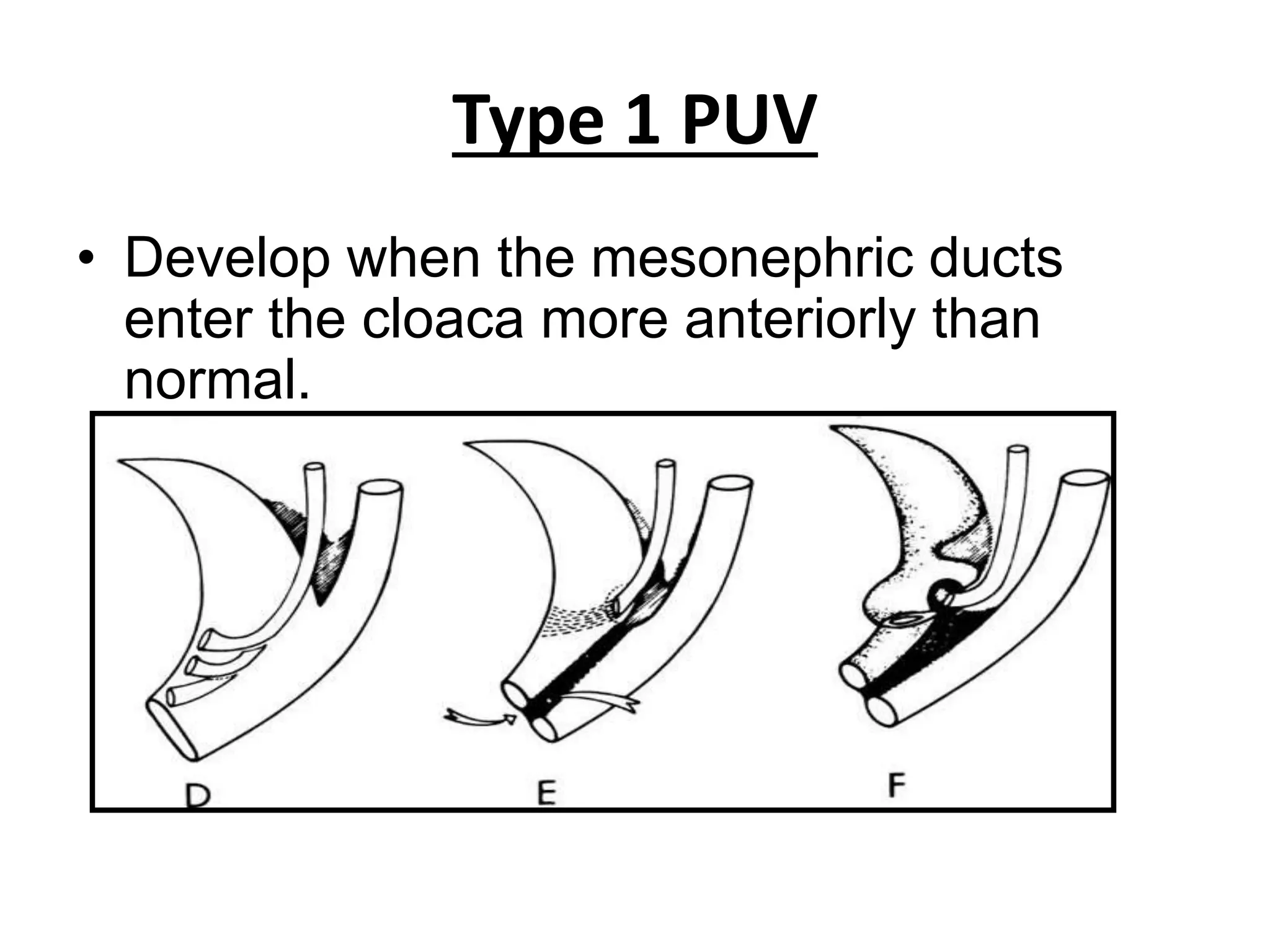 Etiopathogenesis, Evaluation & Management of Posterior Urethral Valve ...