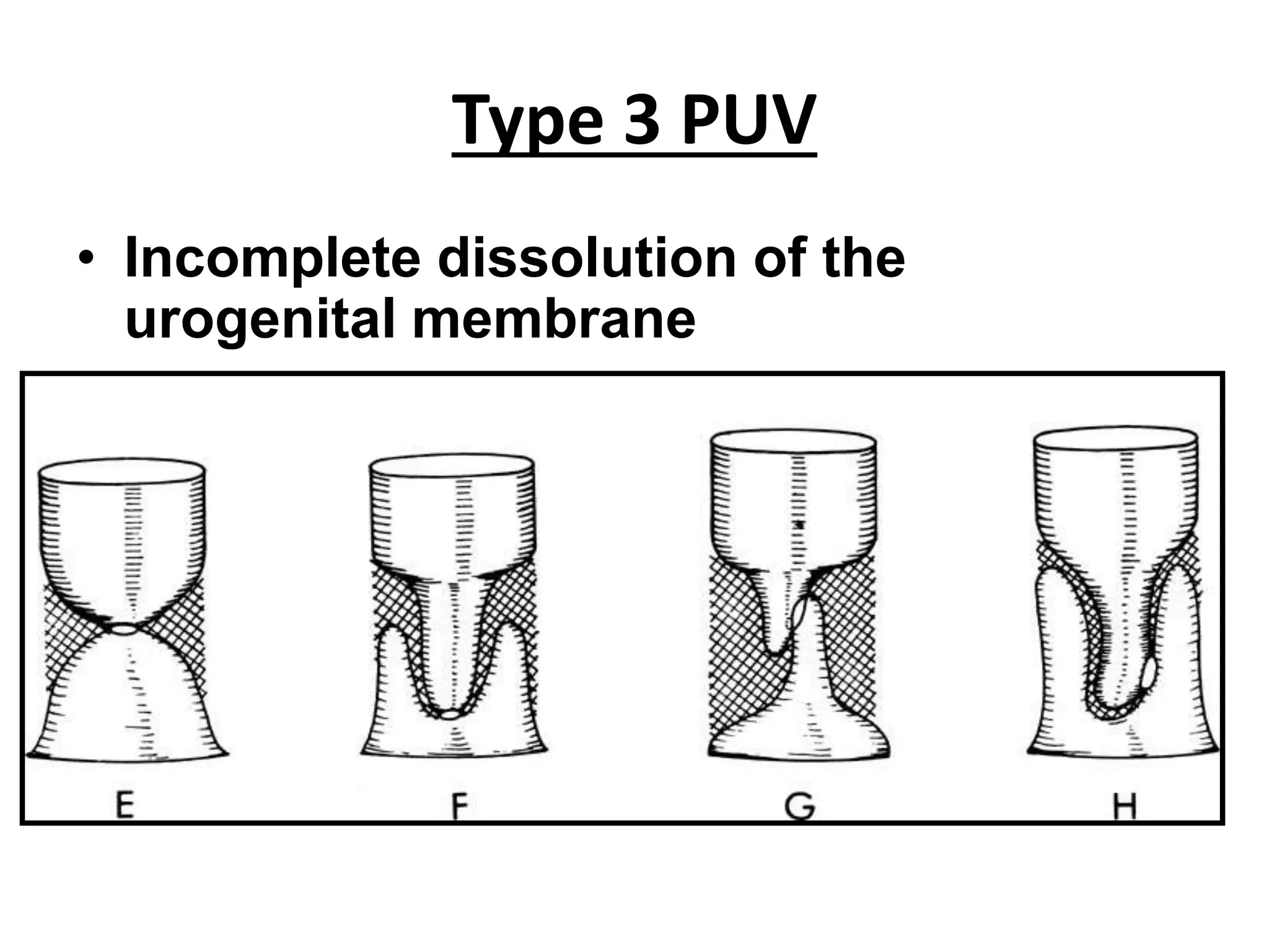 Etiopathogenesis, Evaluation & Management of Posterior Urethral Valve ...