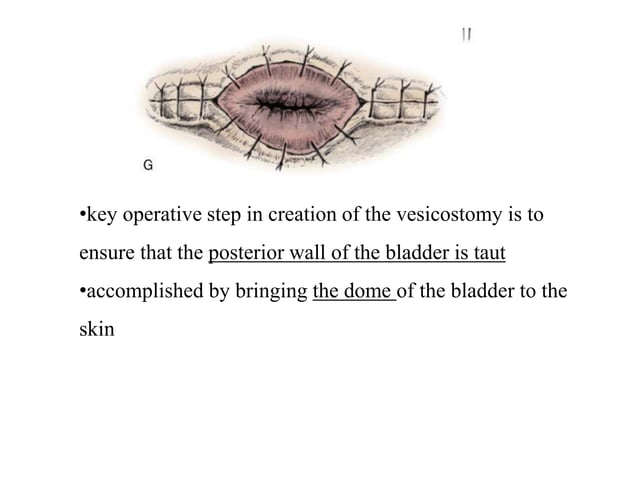 Etiopathogenesis, Evaluation & Management of Posterior Urethral Valve ...