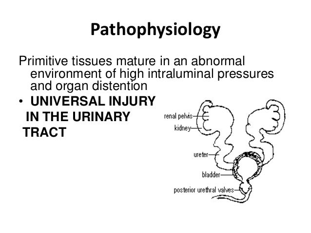 Types Of Posterior Urethral Valves Young 1919