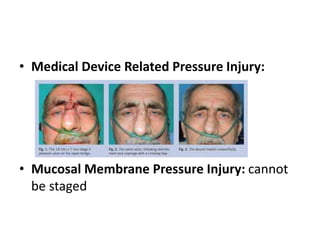 Etiopathogenesis of bed sore | PPT