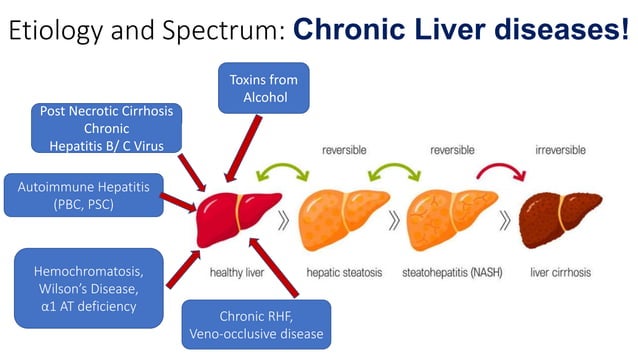 Etiopathogenesis Cirrhosis of Liver | PPT