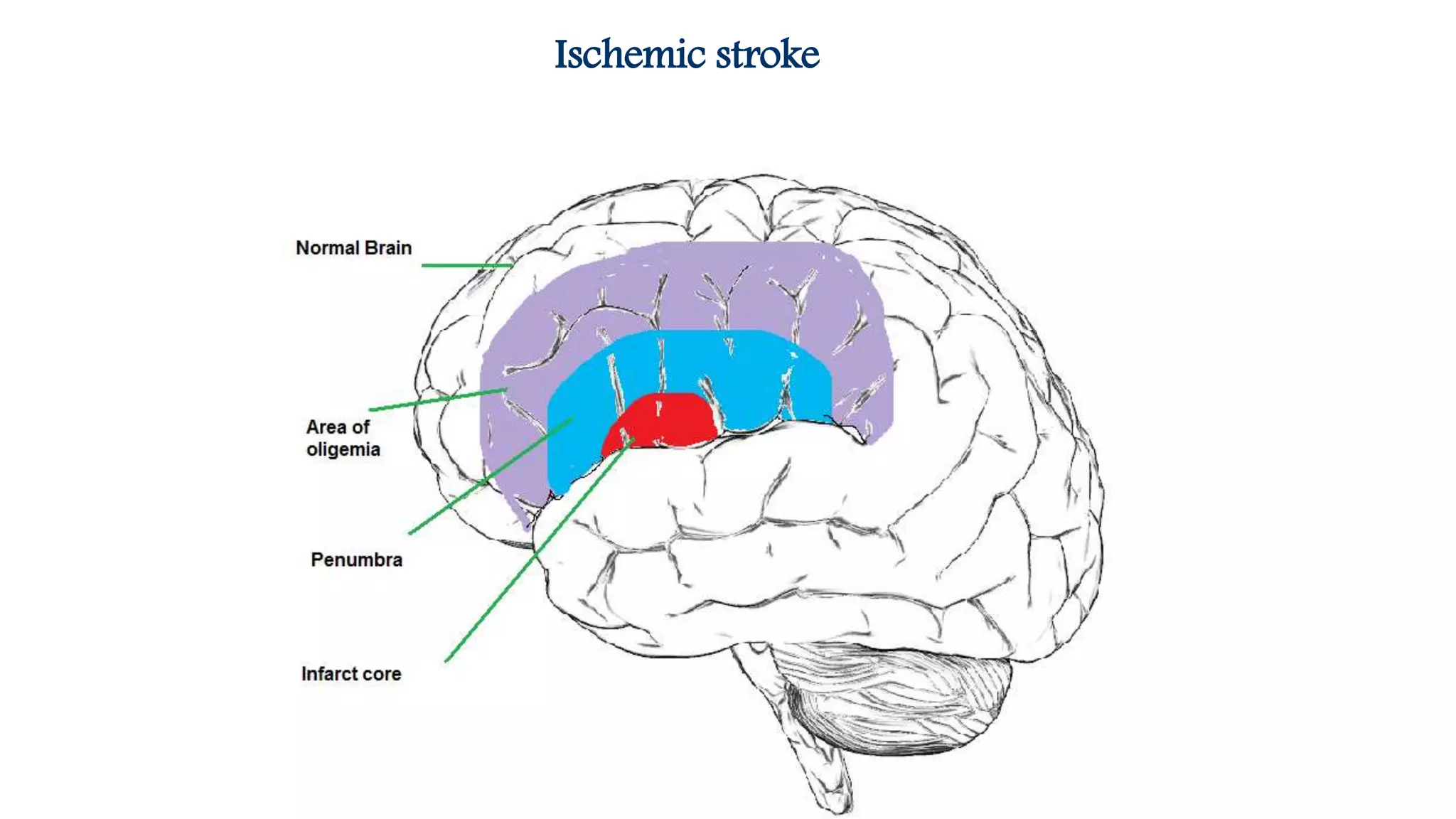 Etiopathogenesis of stroke | PPTX
