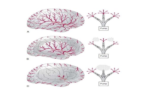 Etiopathogenesis of stroke | PPTX | Brain and Nervous System Disorders ...
