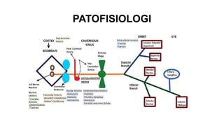 Etiologi, Patofisiologi dan Tatalaksana pada parese N.III.pptx