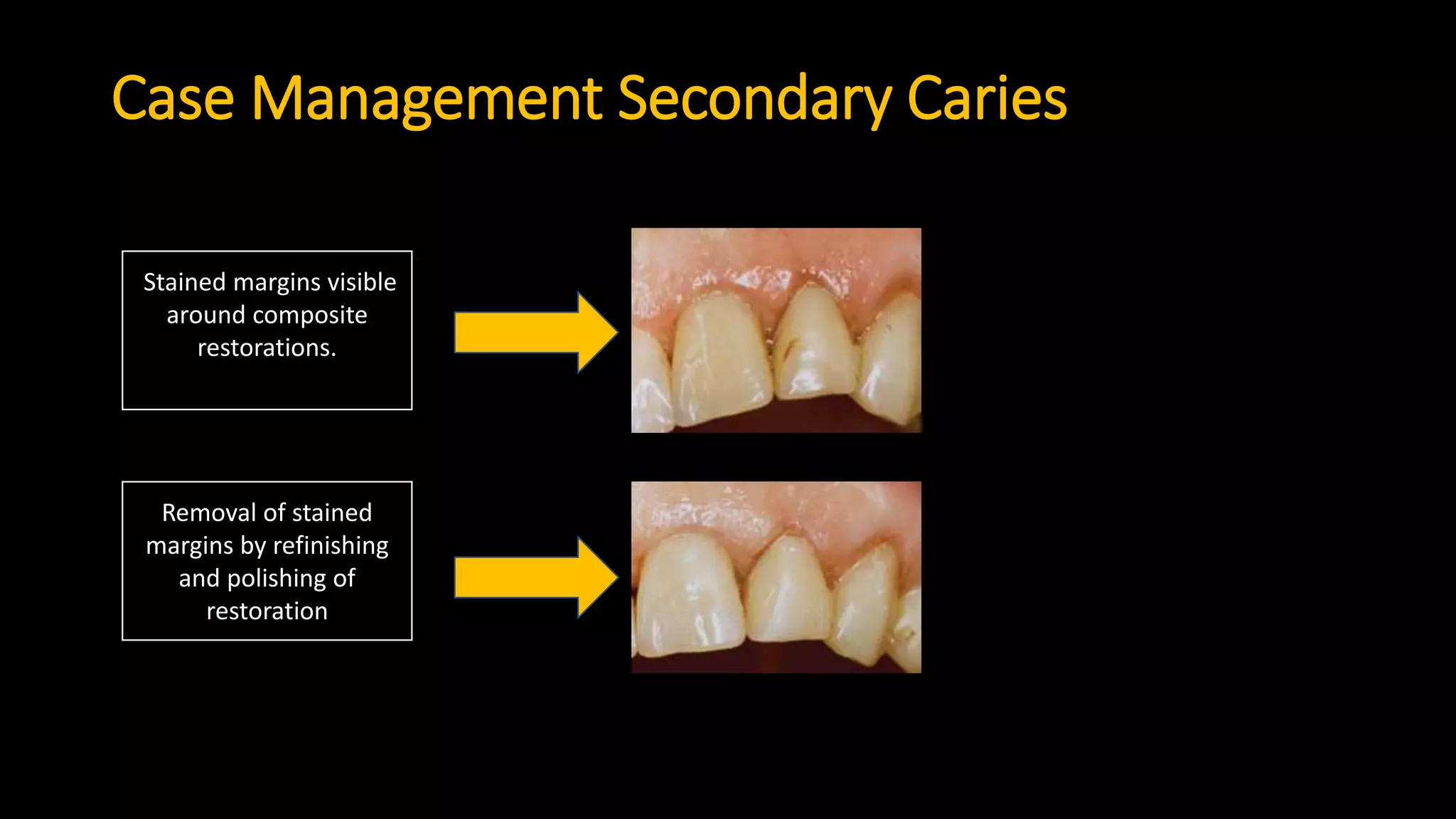 Secondary Caries Overview And Management Pdf