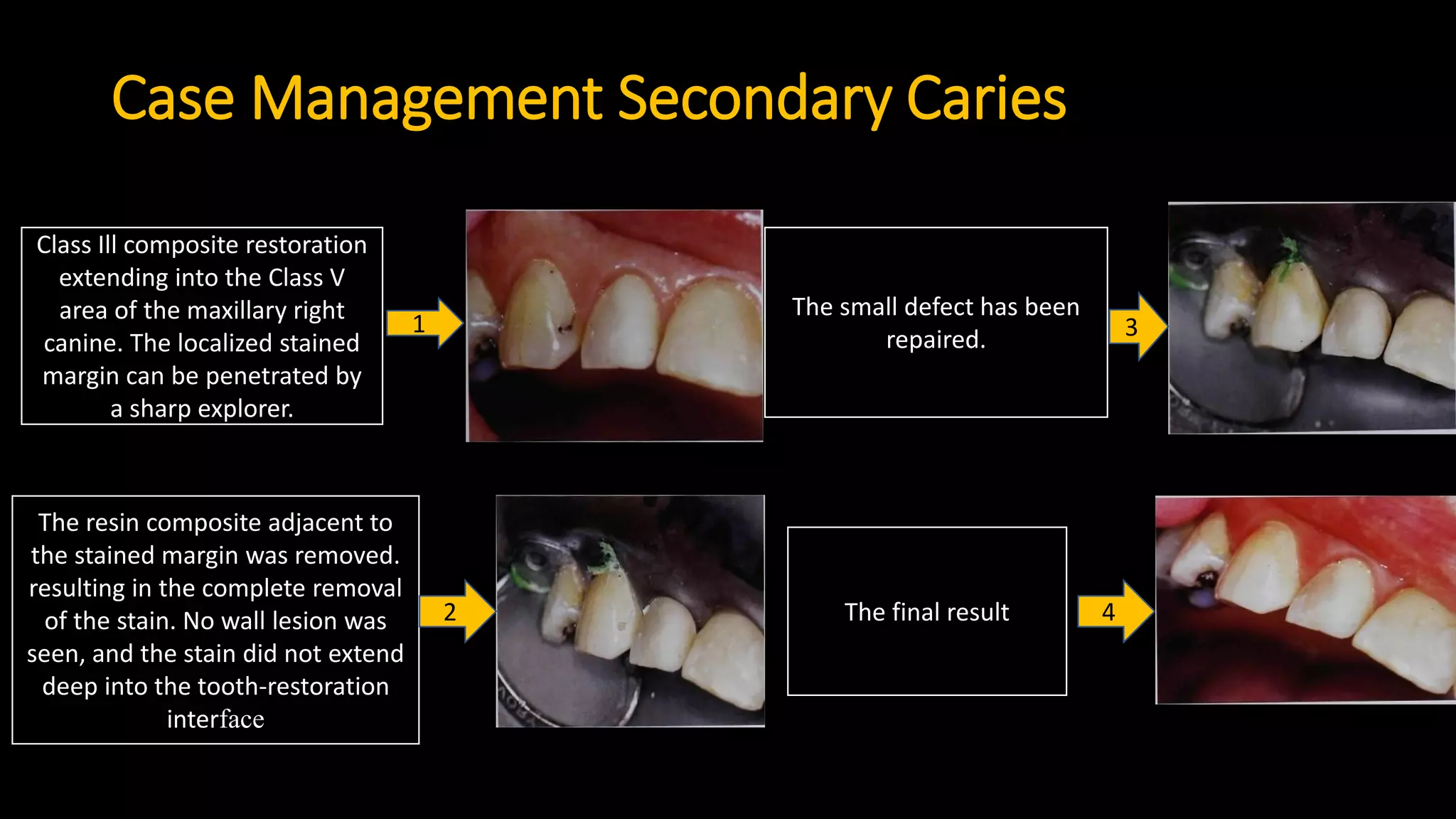 Secondary Caries Overview And Management Pdf
