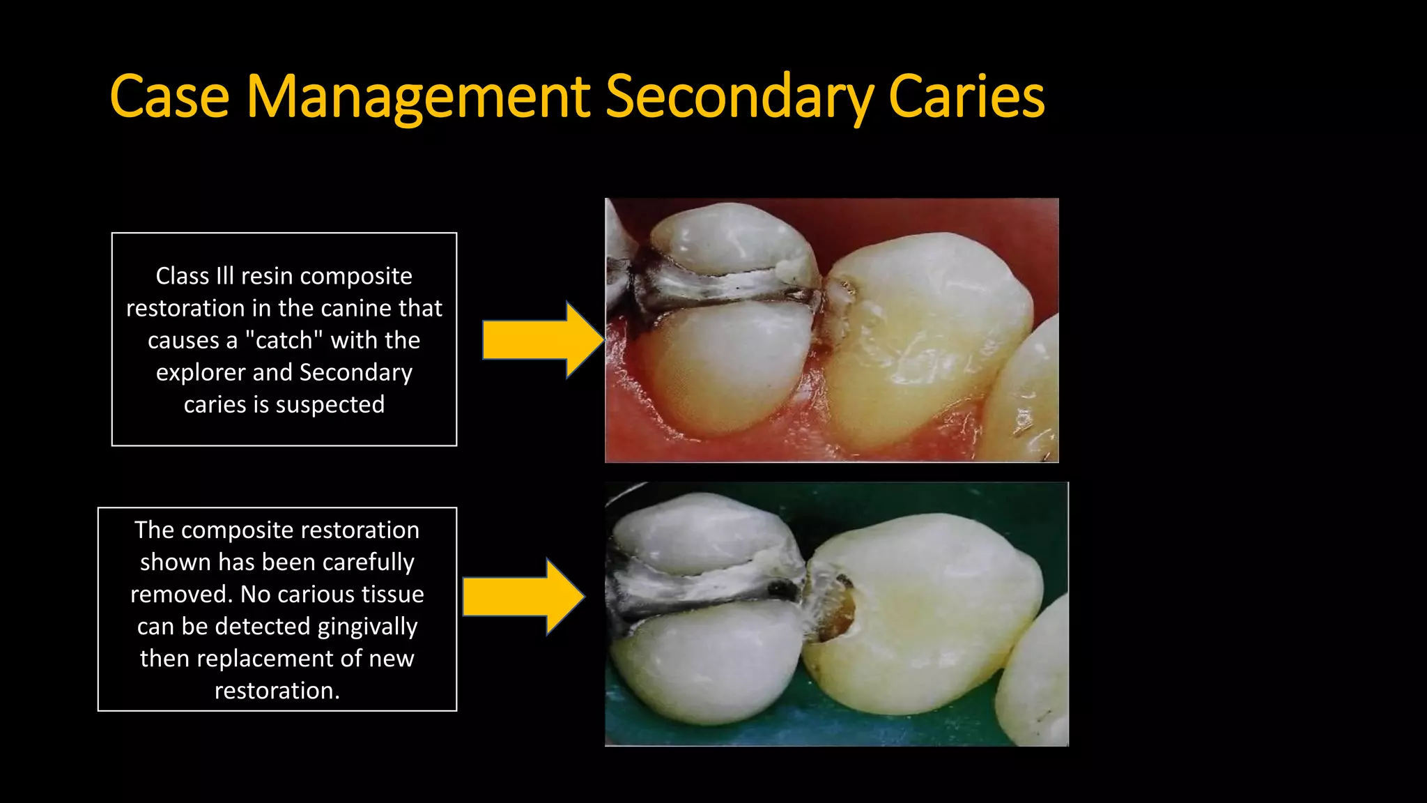 SECONDARY_CARIES_OVERVIEW_AND_MANAGEMENT.pdf