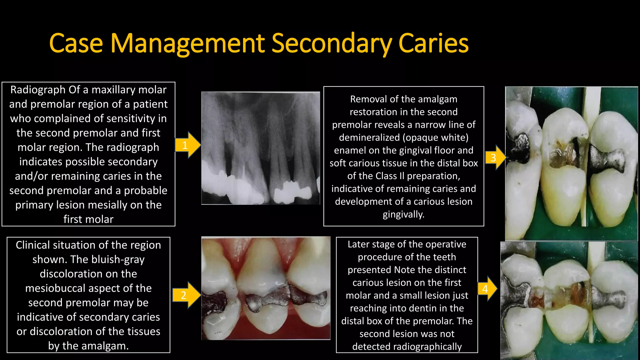 Secondary Caries Overview And Management Pdf