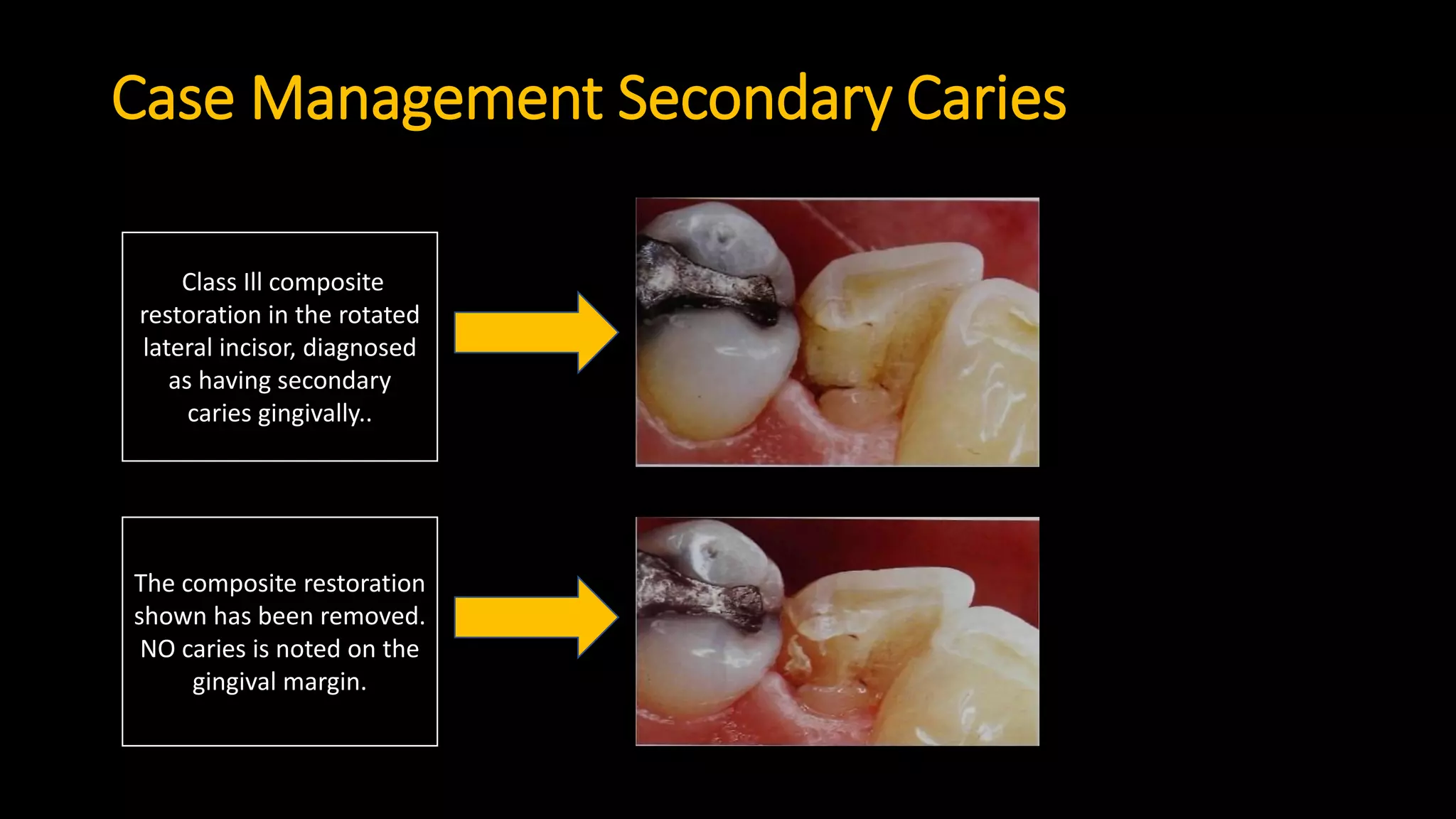 Secondary Caries Overview And Management Pdf