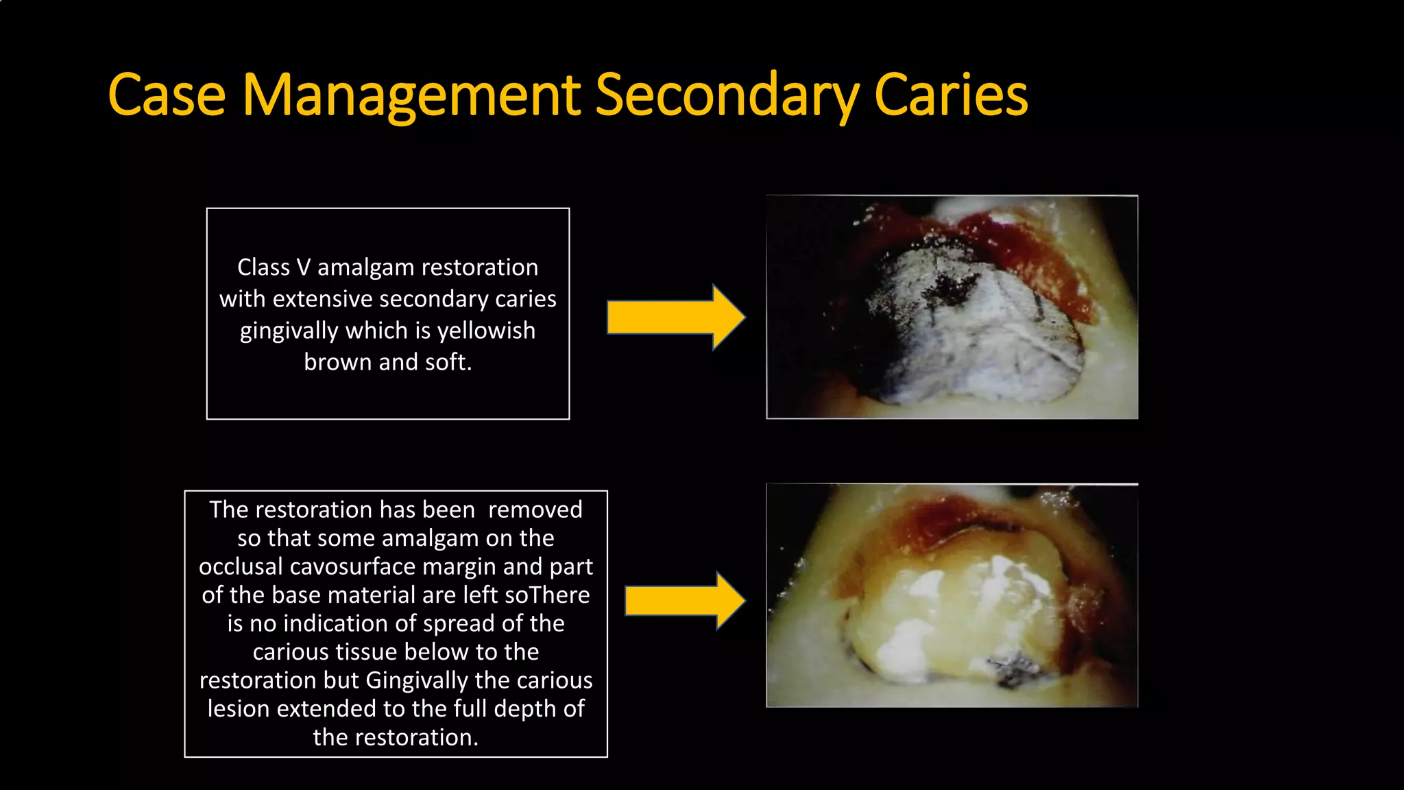 SECONDARY_CARIES_OVERVIEW_AND_MANAGEMENT.pdf