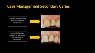 SECONDARY_CARIES_OVERVIEW_AND_MANAGEMENT.pdf