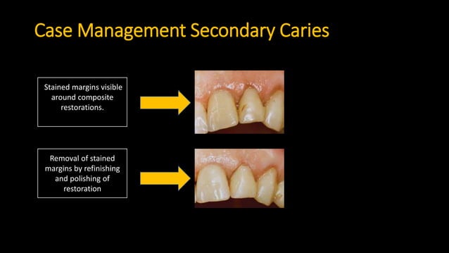 Secondary Caries Overview And Management Pdf