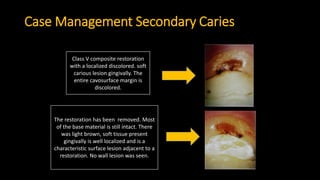 SECONDARY_CARIES_OVERVIEW_AND_MANAGEMENT.pdf