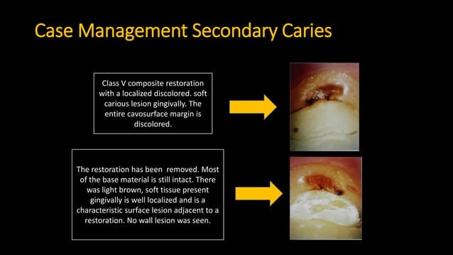 SECONDARY_CARIES_OVERVIEW_AND_MANAGEMENT.pdf