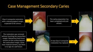 SECONDARY_CARIES_OVERVIEW_AND_MANAGEMENT.pdf