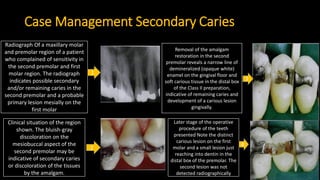 SECONDARY_CARIES_OVERVIEW_AND_MANAGEMENT.pdf