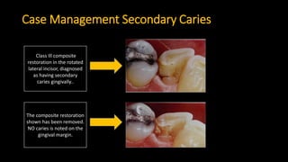 SECONDARY_CARIES_OVERVIEW_AND_MANAGEMENT.pdf