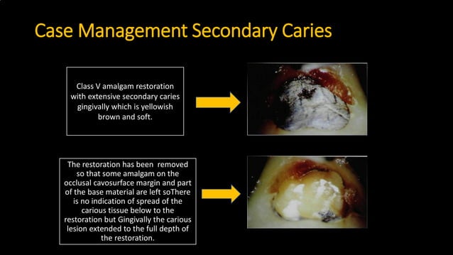 SECONDARY_CARIES_OVERVIEW_AND_MANAGEMENT.pdf