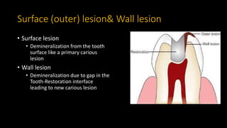 SECONDARY_CARIES_OVERVIEW_AND_MANAGEMENT.pdf
