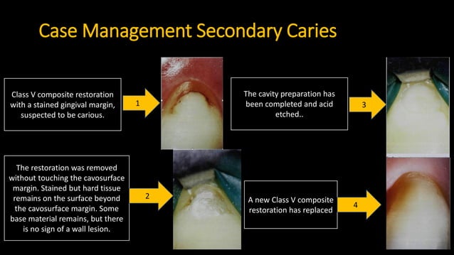 Secondary Caries Overview And Management Pdf