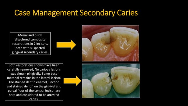 Secondary Caries Overview And Management Pdf