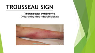 Trousseaus Syndrome