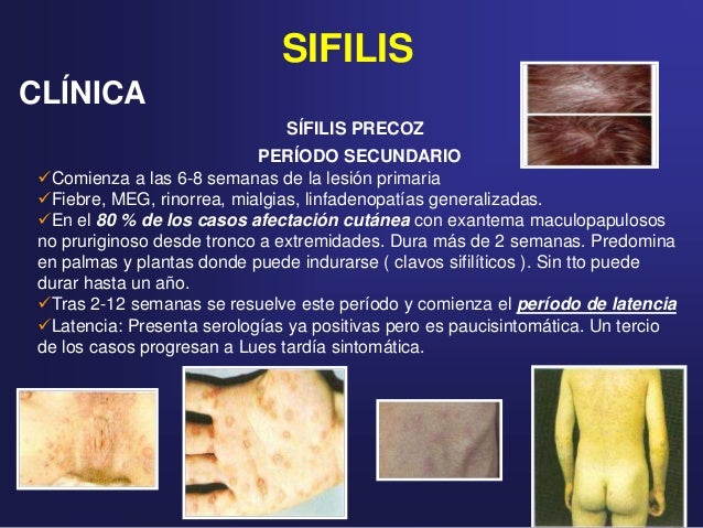 infecciones de transmisión sexual sifilis y gonorrea
