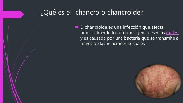 Qu Es El Chancro Blando O Chancroide Vacunas Para Viajar