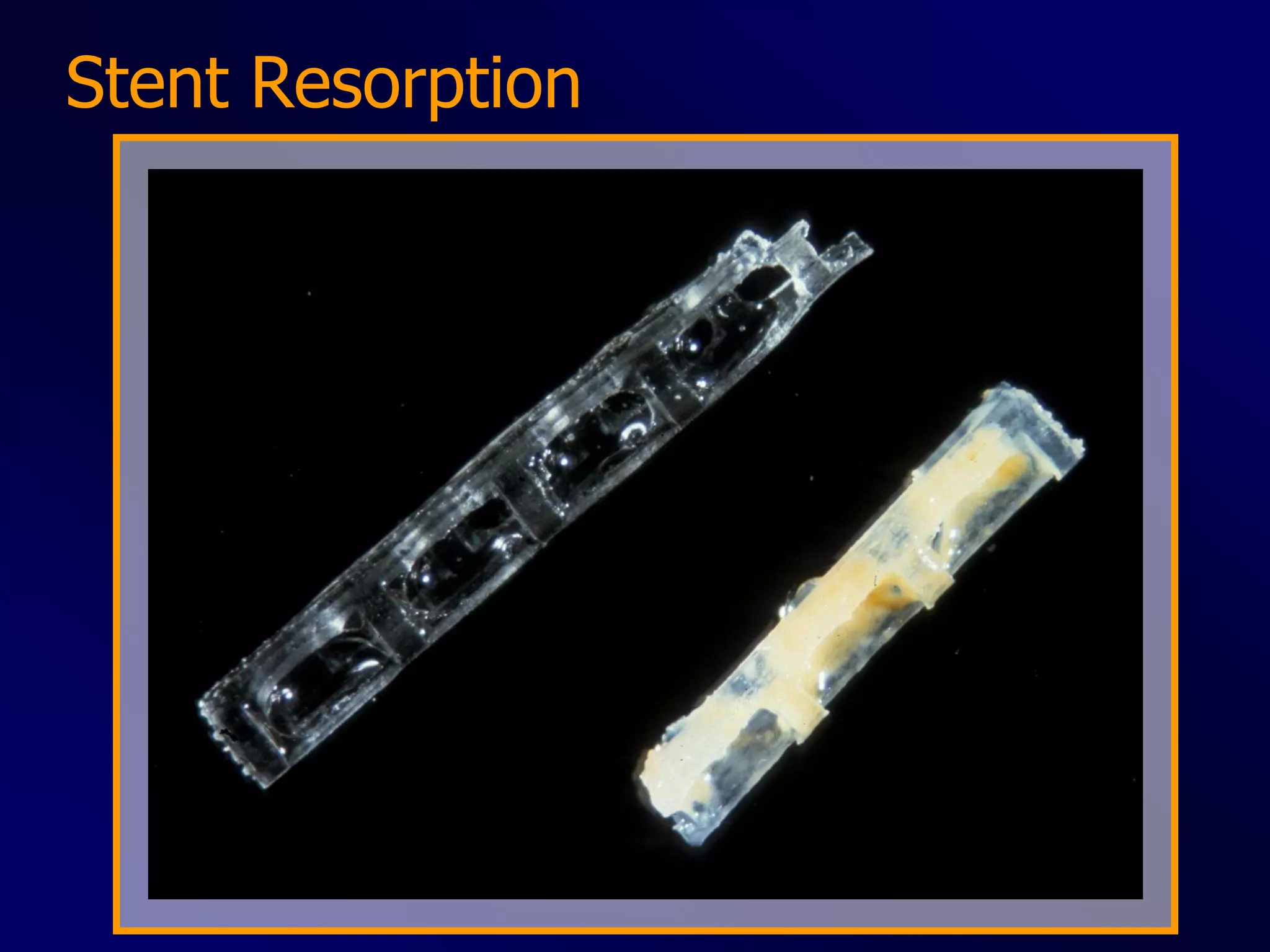 Eustachian Tube Stent | PDF | Ear, Nose and Throat Conditions ...