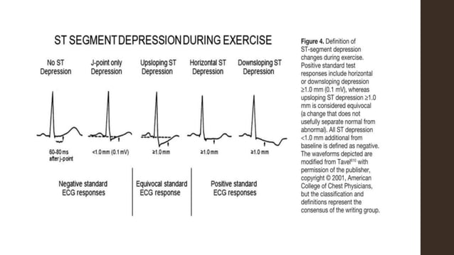 Exercise tolerance test | PPTX