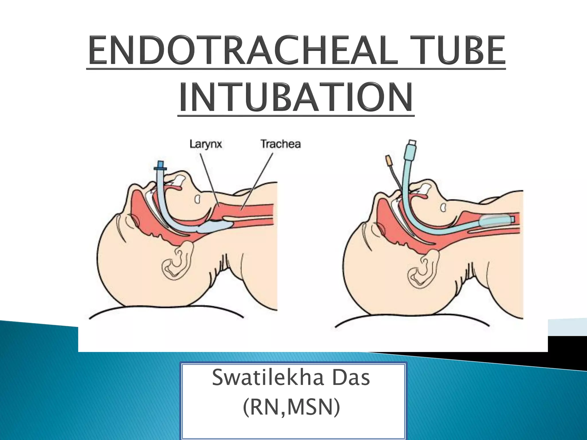 ENDOTRACHEAL TUBE INTUBATION II Parts II Details II Clinical Discussion ...