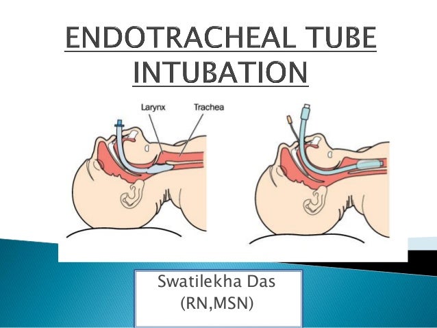 Endotracheal Intubation Procedure Intubation Causes