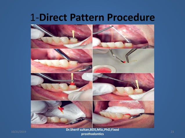 restoration of endodontically treated teeth cast post | PPTX | Dental ...