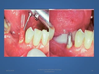 restoration of endodontically treated teeth cast post | PPTX
