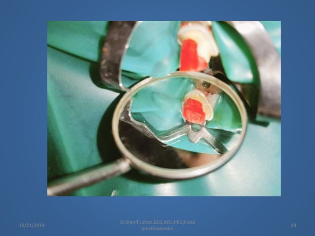 restoration of endodontically treated teeth cast post | PPTX | Dental ...