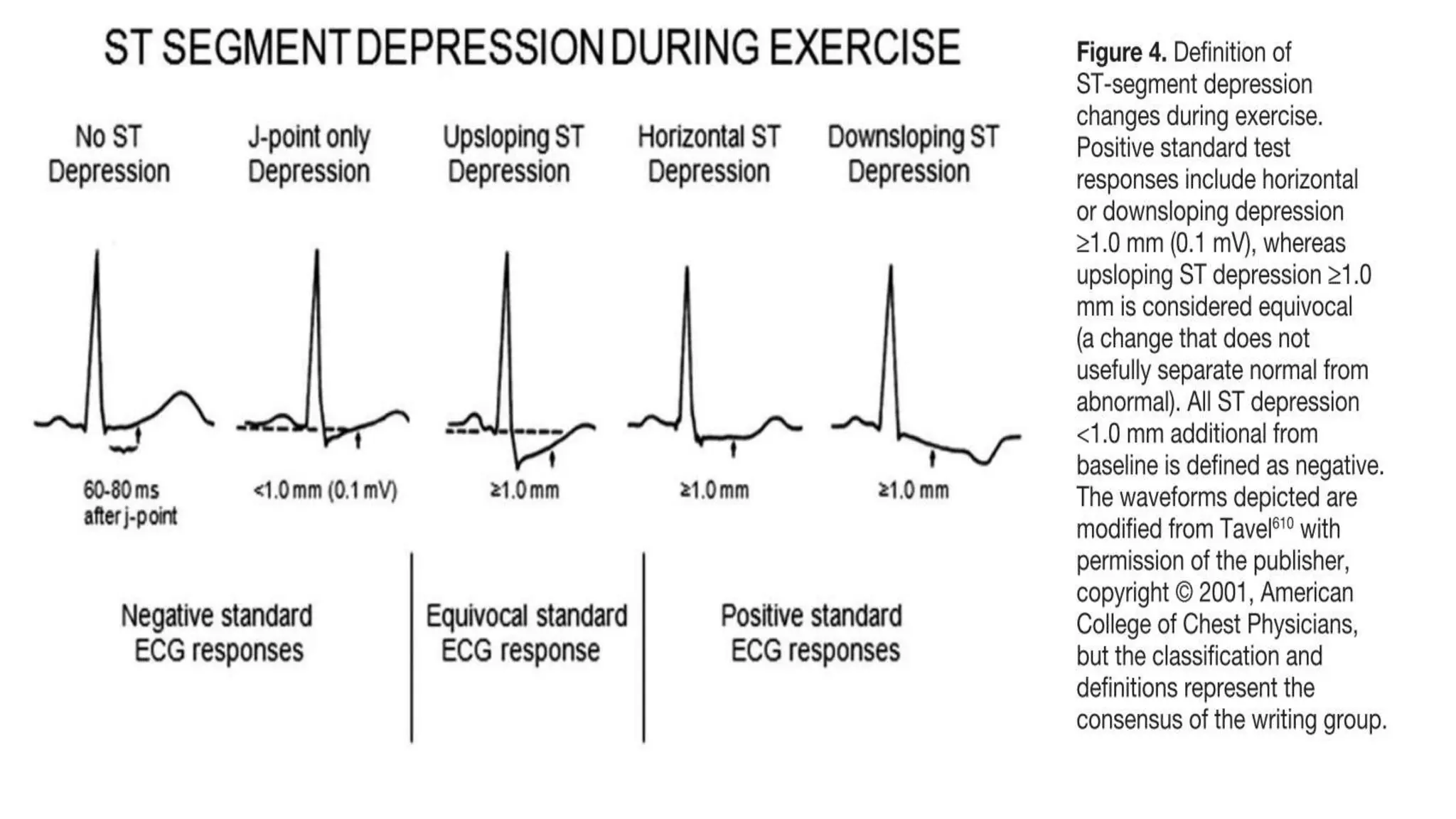 Exercise Tolerance Test | PPTX