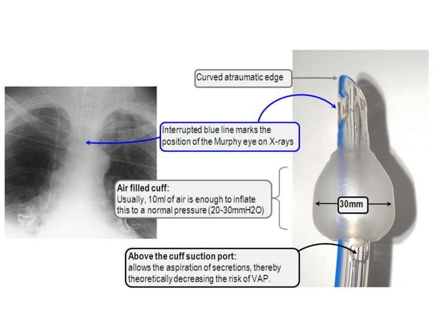 Endotracheal Tube and Laryngeal Mask Airway | PPTX