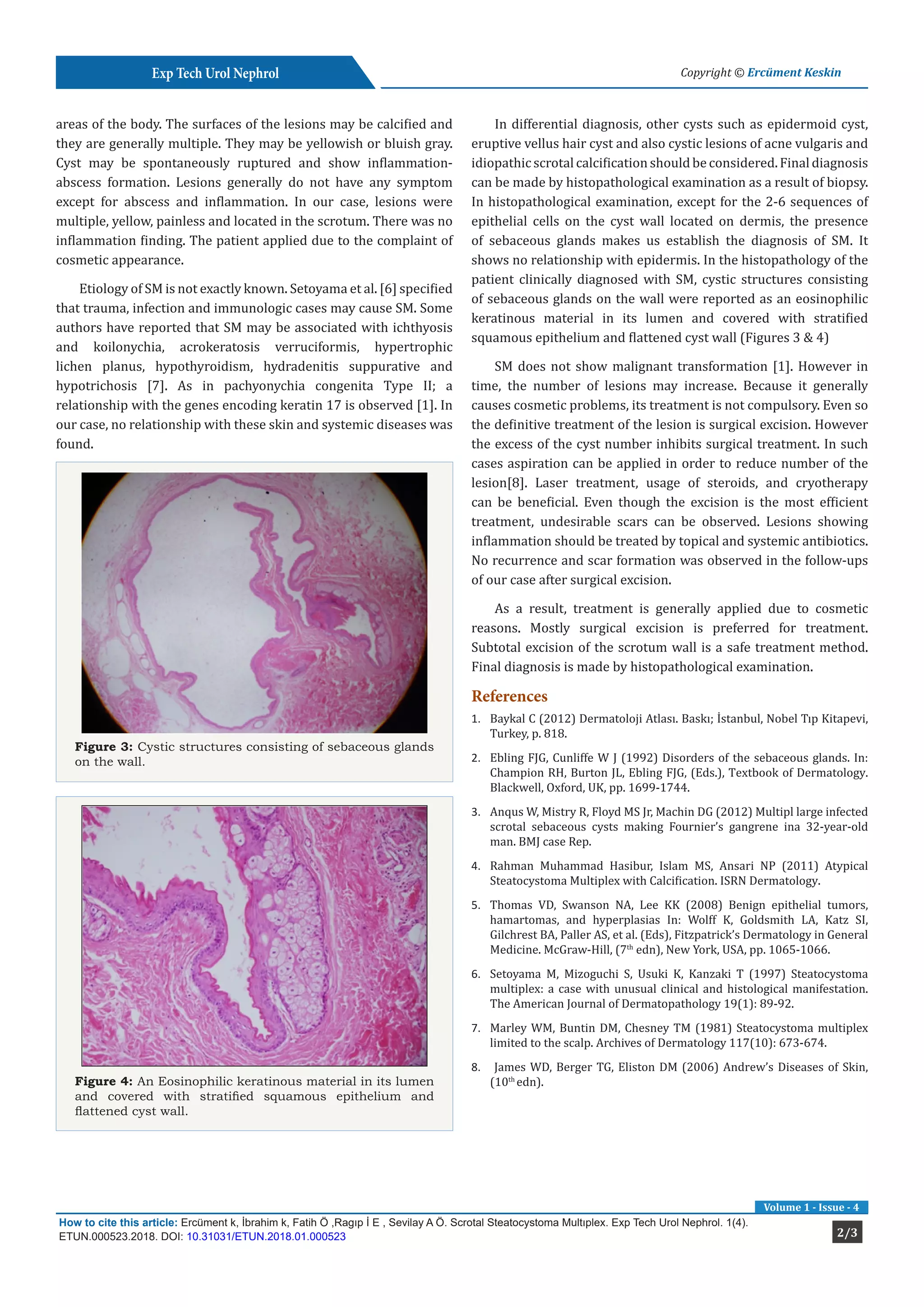 Scrotal Steatocystoma Multıplex: Journal of Nephrology: Crimson ...