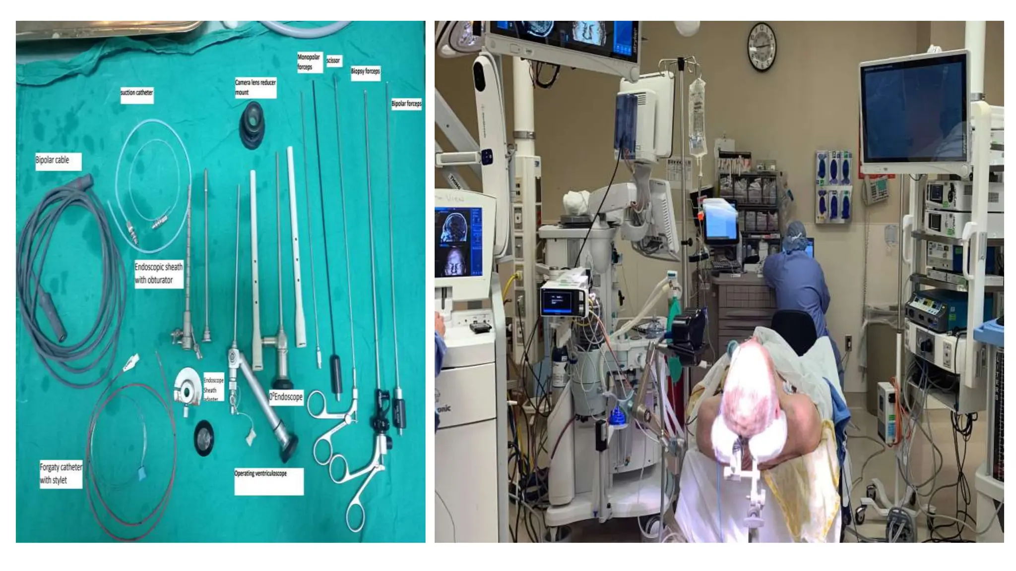 Endoscopic 3rd Ventriculostomy-DR.MUMTAZ ALI NAREJO.pptx