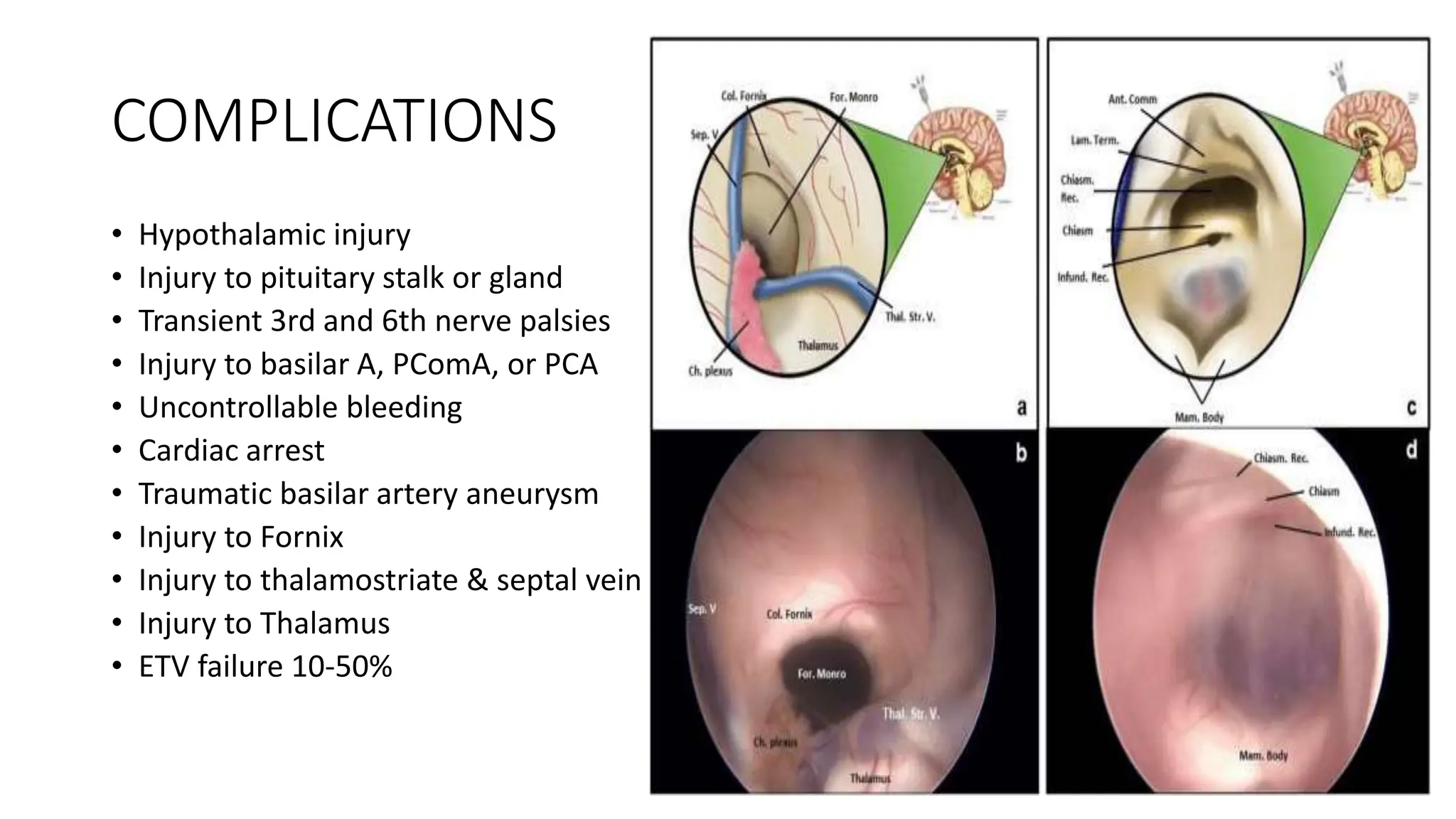 Endoscopic 3rd Ventriculostomy-DR.MUMTAZ ALI NAREJO.pptx